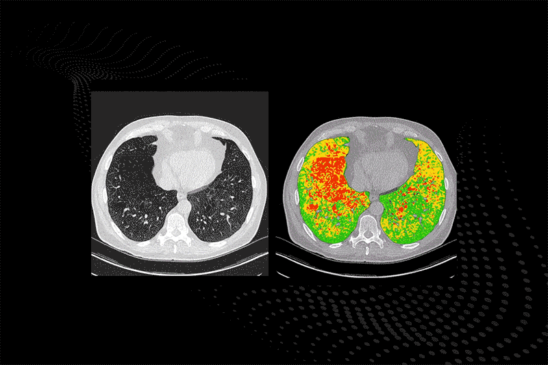 Lung Density Analysis™ - Functional - 4DMedical
